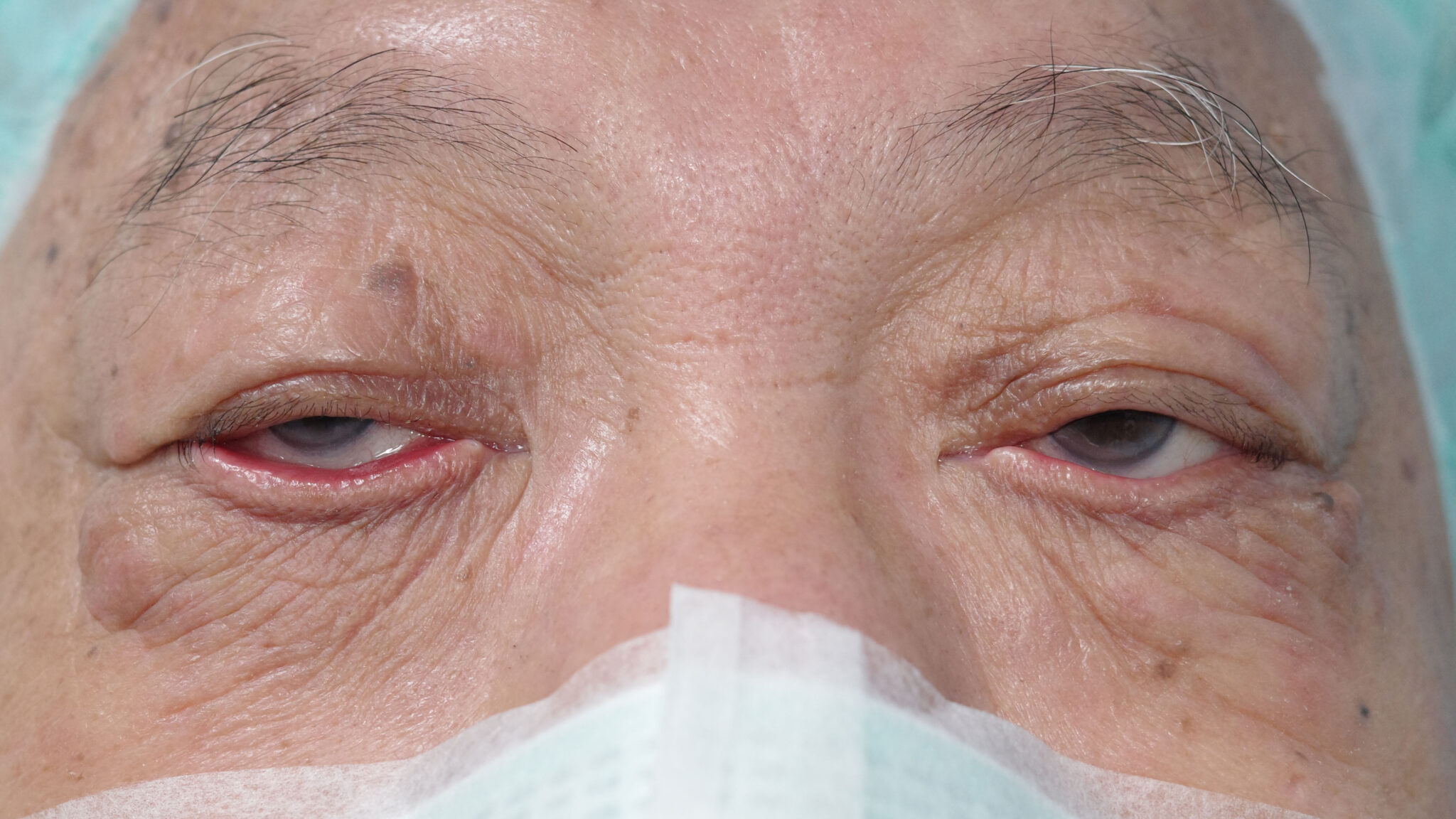 Understanding Entropion and Ectropion - drartvorarit.com