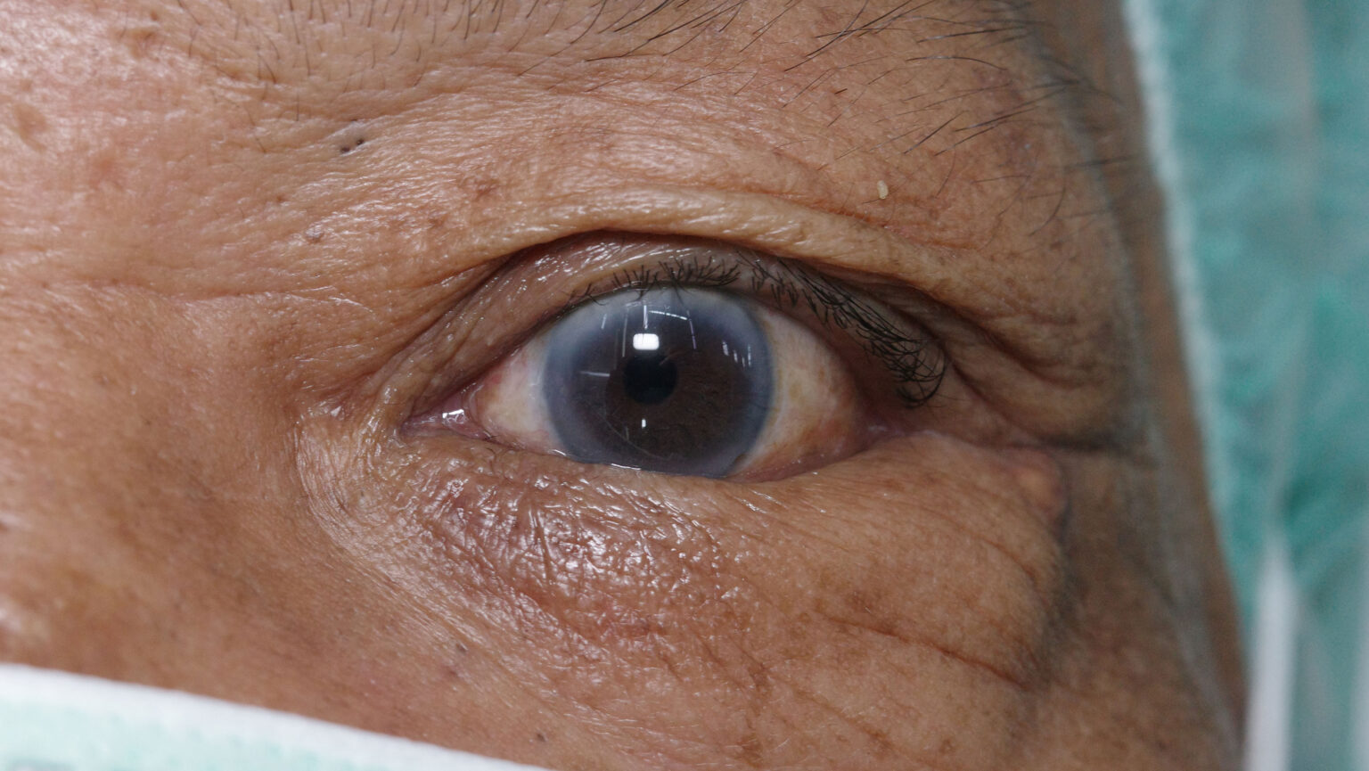 Understanding Entropion and Ectropion - drartvorarit.com