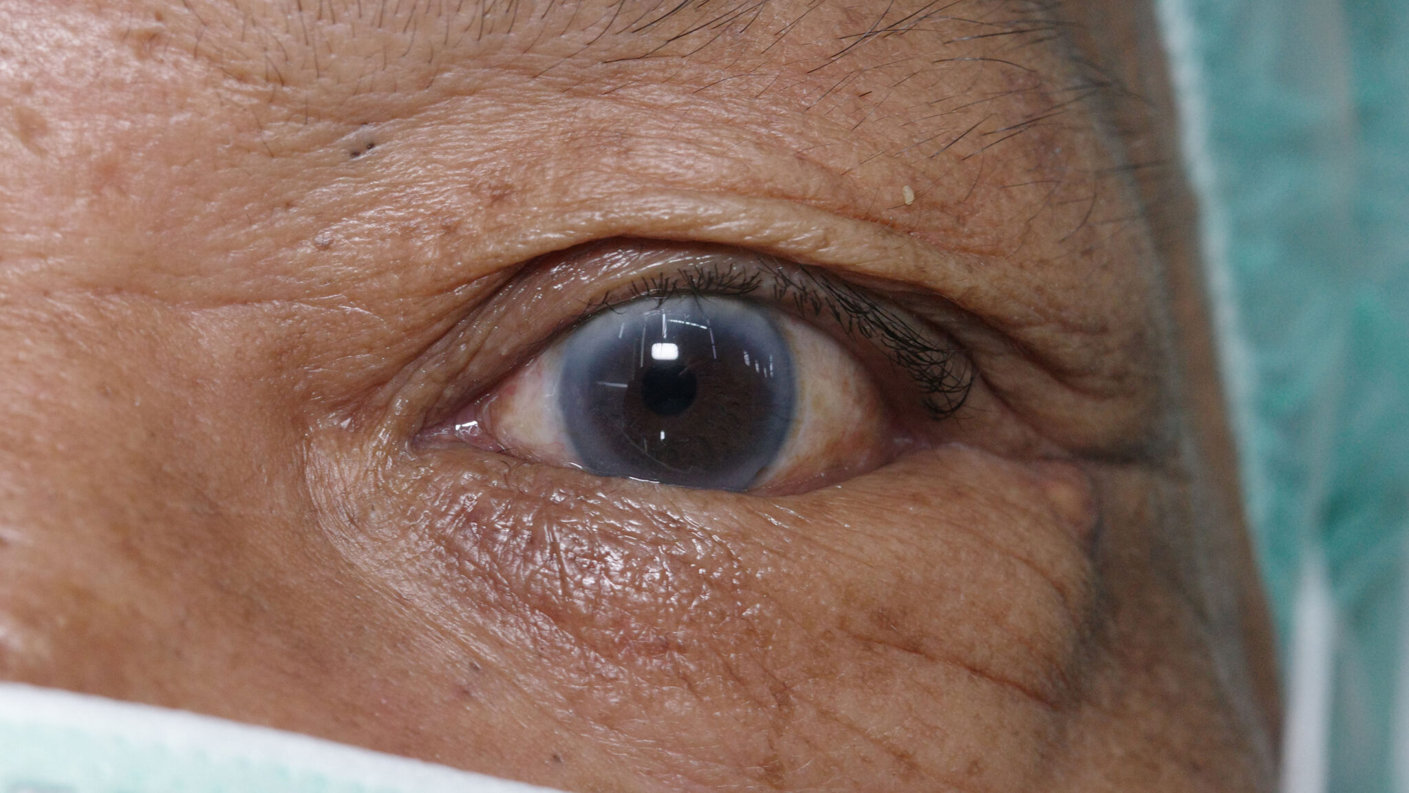 Understanding Entropion and Ectropion - drartvorarit.com